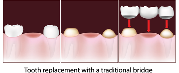 Dental Bridges | Olympic Dental of Sugar Land (281) 240-2545